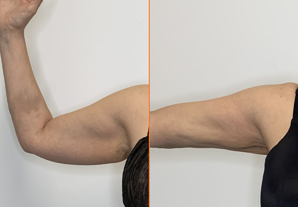Arm Lipo Case 44 | Just Go Lipo